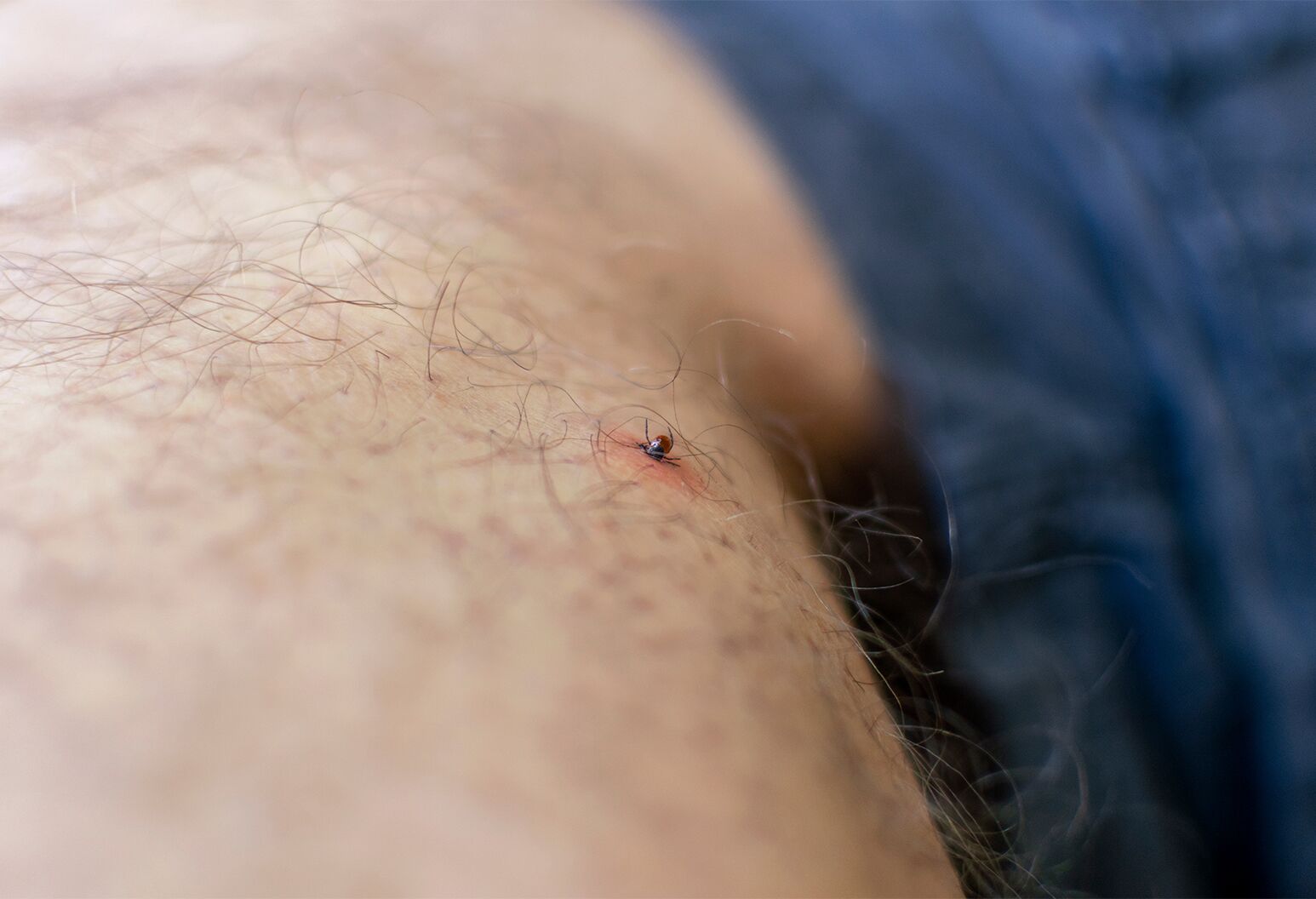 When To Worry About A Tick Bite | The Well by Northwell