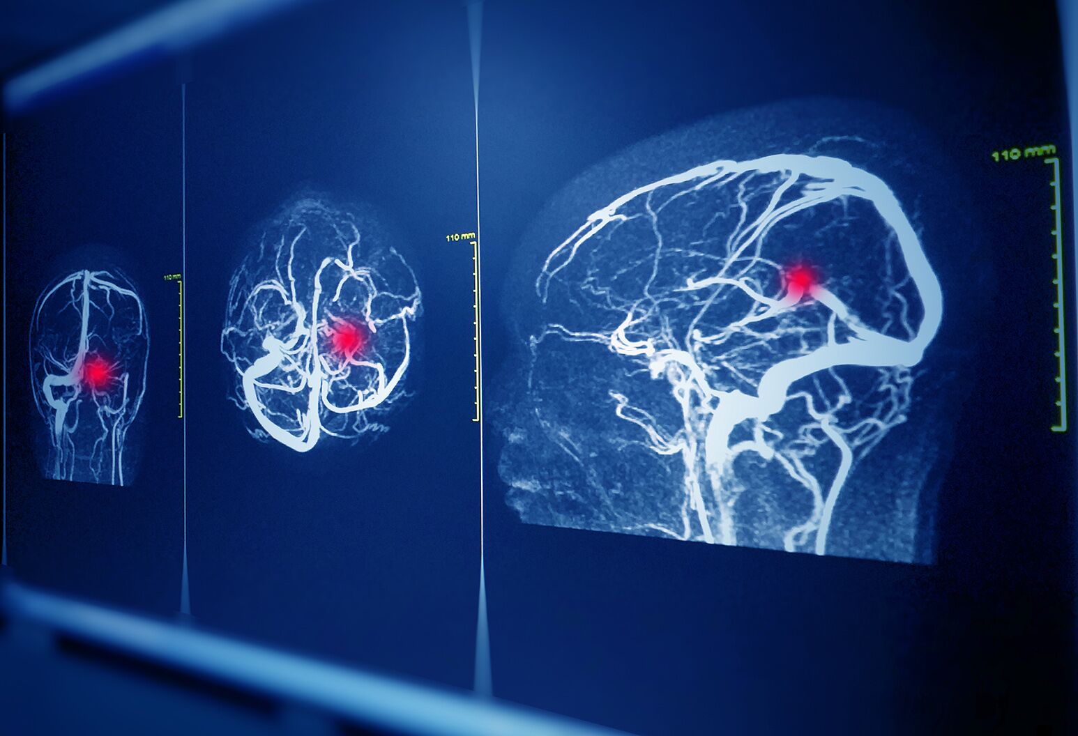 Center for Cerebrovascular & Neuroendovascular Surgery - Institute for ...