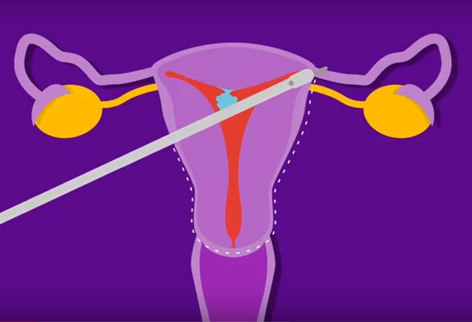 Minimally invasive gynecologic surgery | Northwell Health