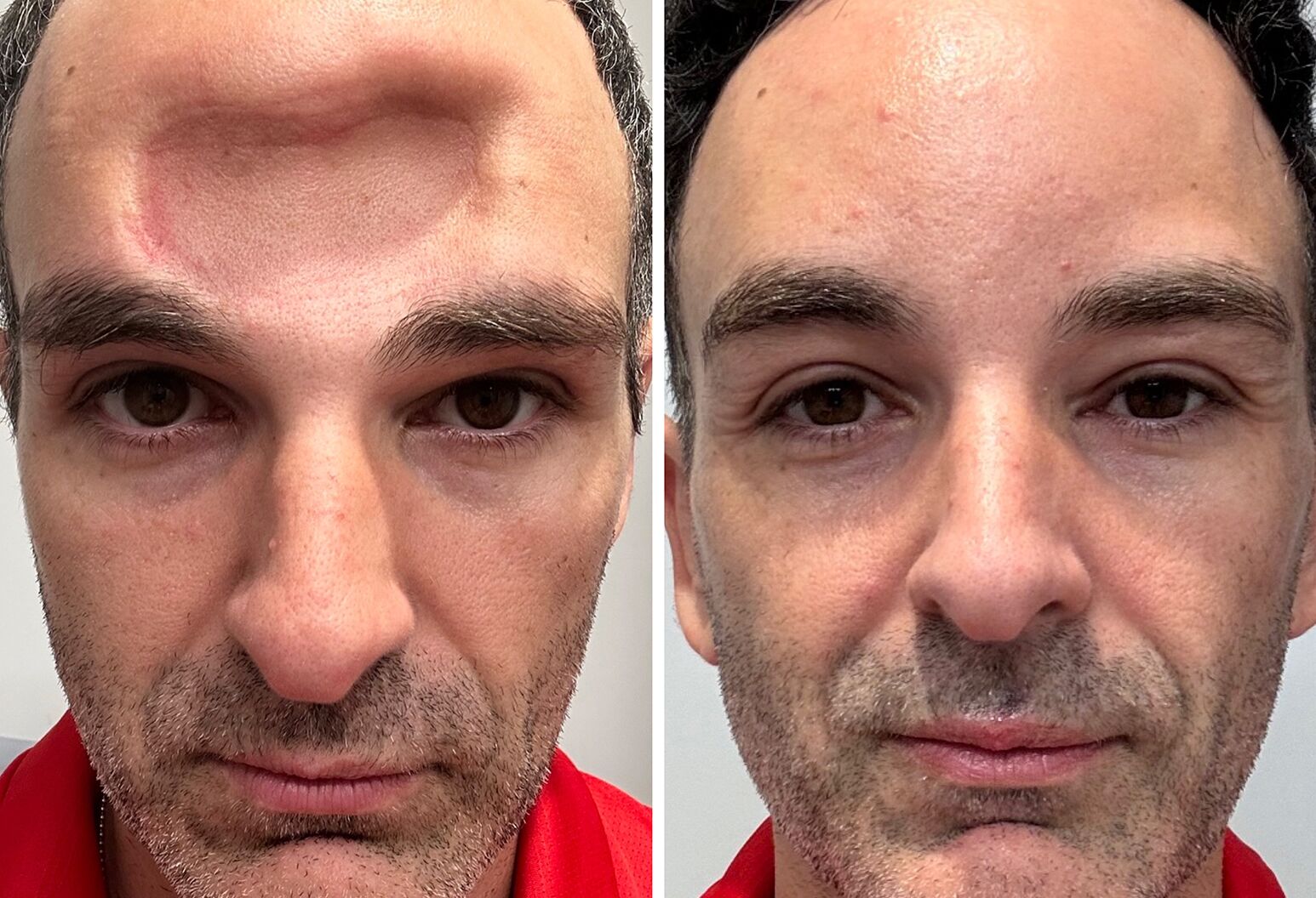 Cranioplasty Improving Life After Skull Injury Northwell Health Cranioplasty Improving Life After Skull Injury Northwell Health