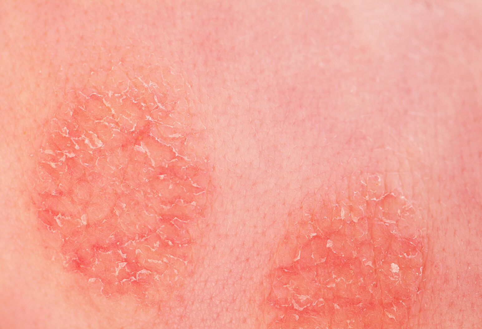 Understanding Common Rashes In Kids | The Well by Northwell