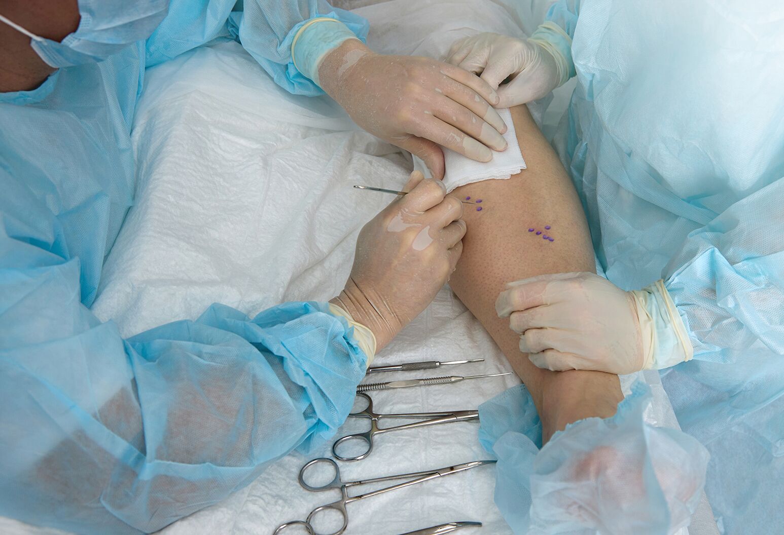 Microphlebectomy - Vein Care | Northwell Health