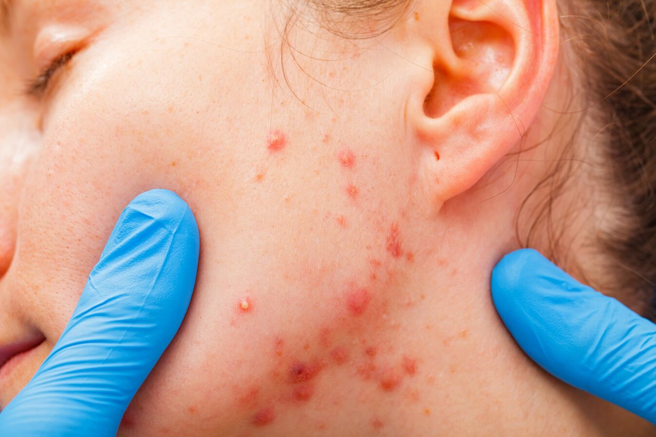 Measles is back in 2 states — what to know before the next outbreak ...