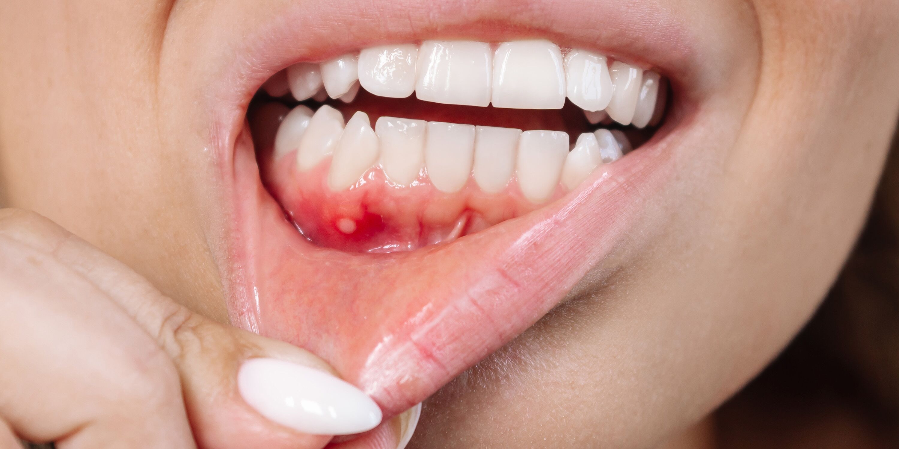 Bumps On The Back Of Your Tongue: Is It Cancer? | The Well by Northwell