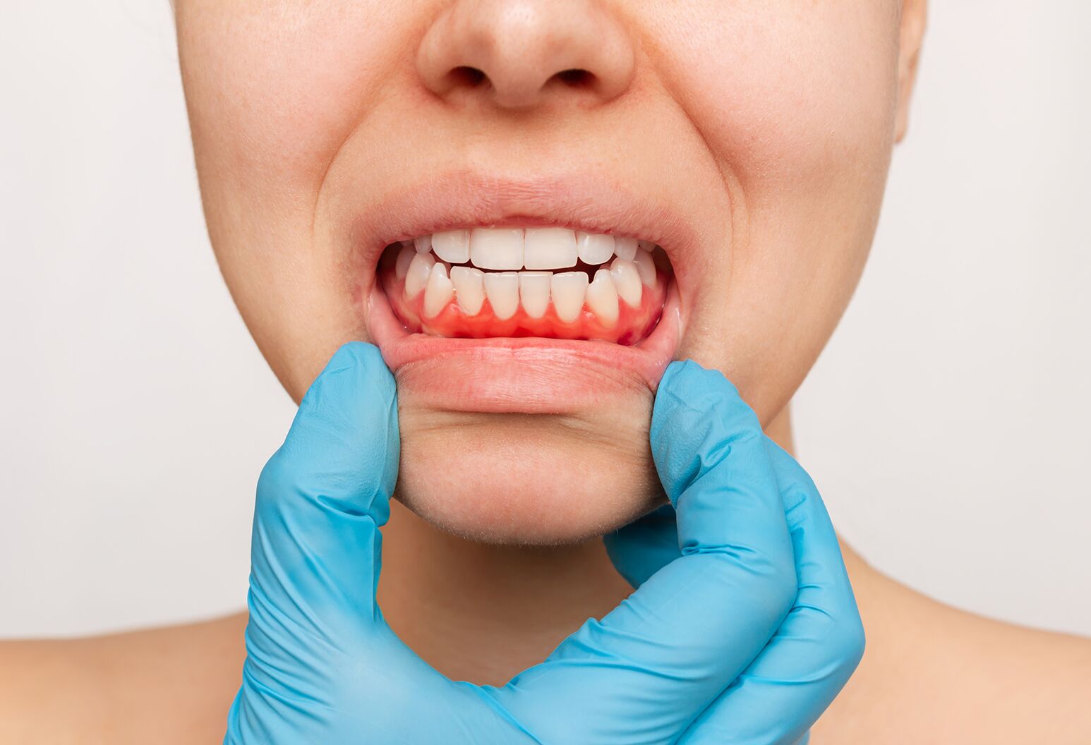 Gum disease stages, causes and treatments | Northwell Health
