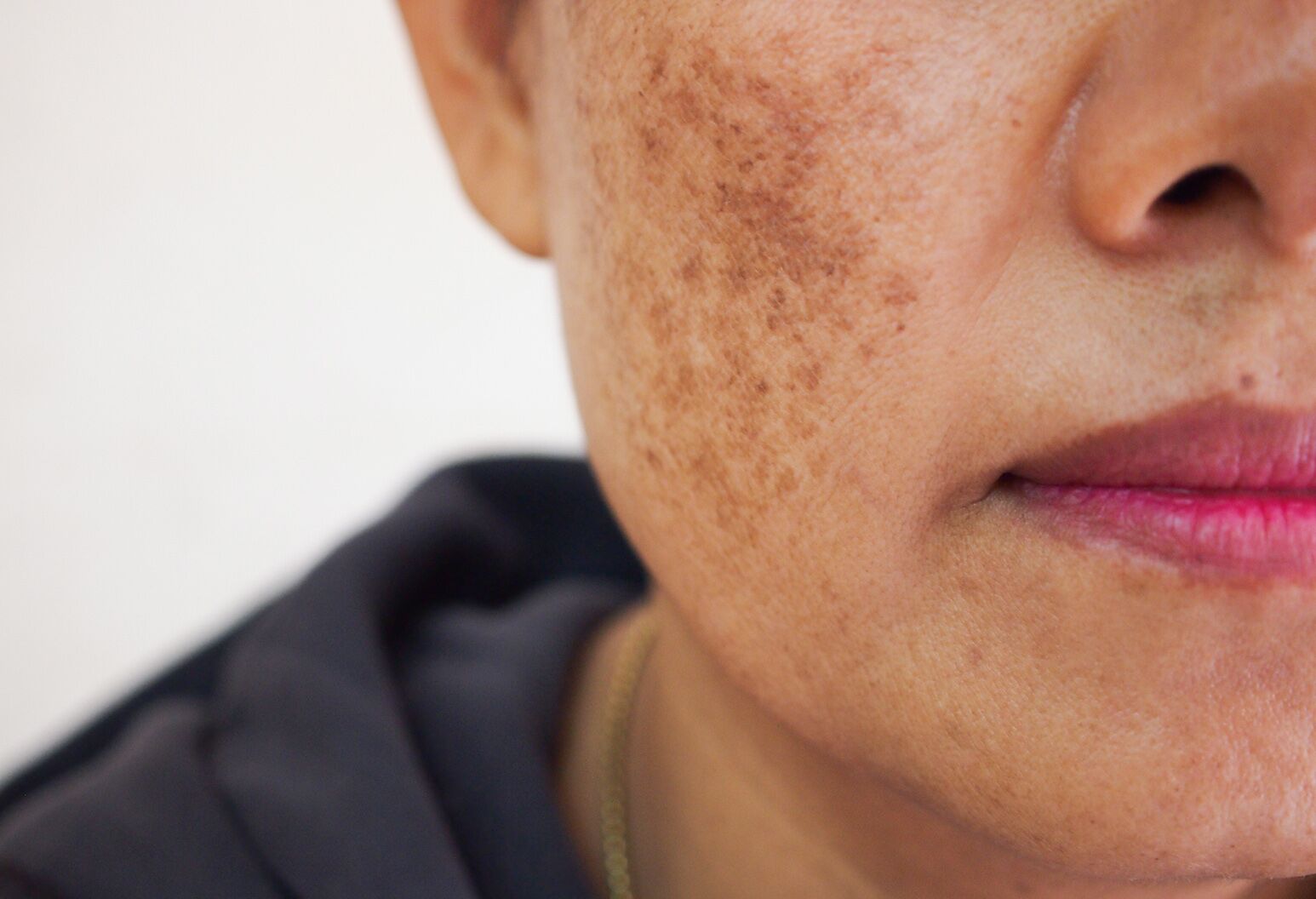 What You Need To Know About Skin Hyperpigmentation The Well By Northwell