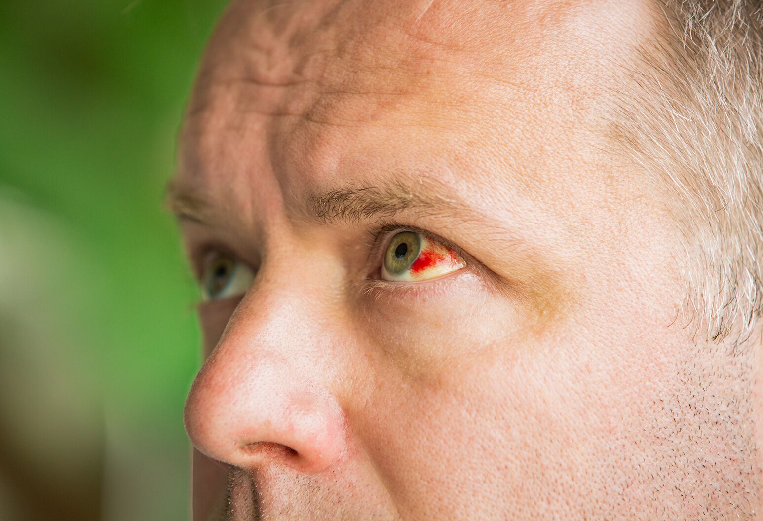 Subconjunctival Hemorrhage: Bleeding Eyes Causes | The Well by Northwell