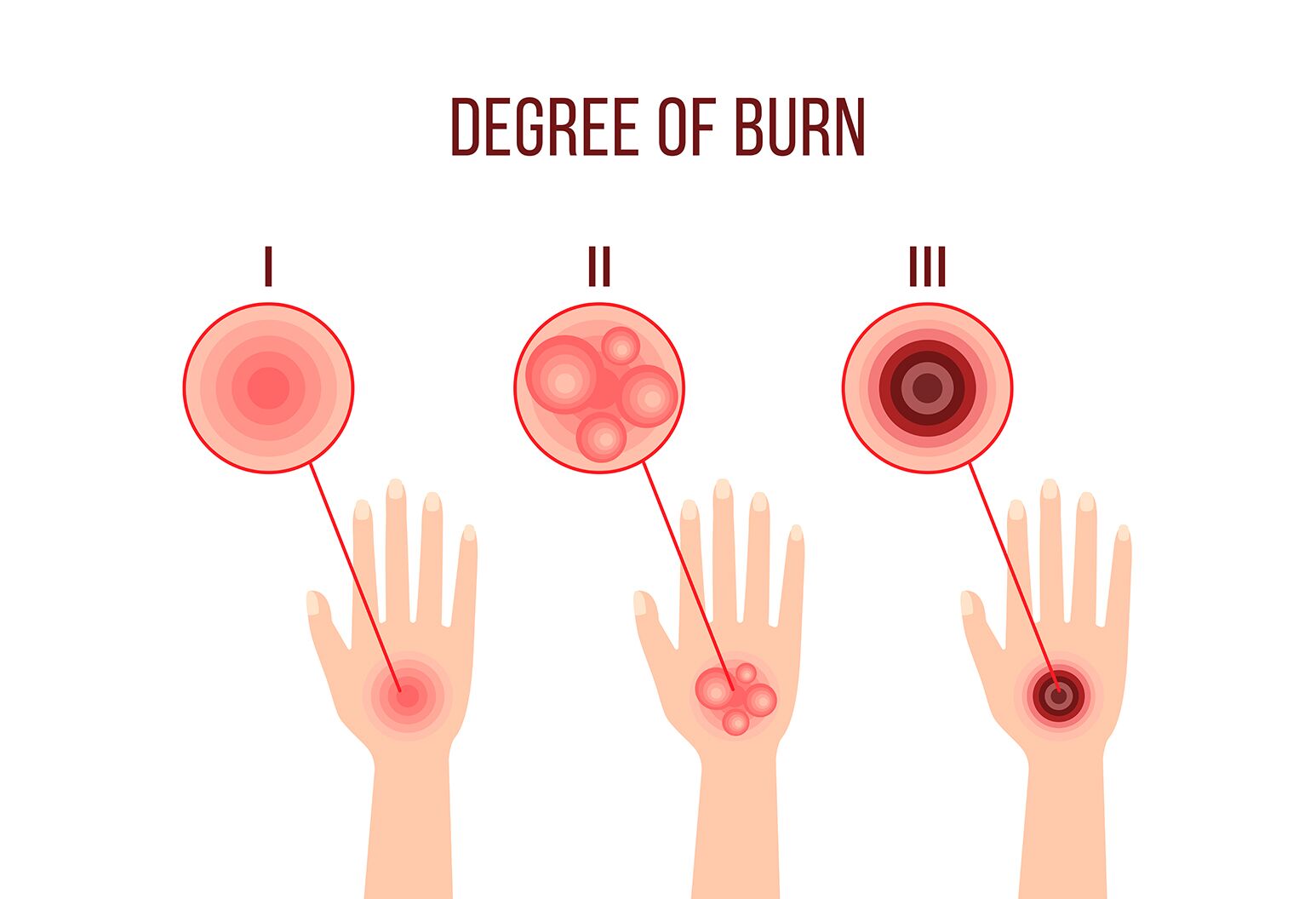 3rd Degree Burns On Fingers
