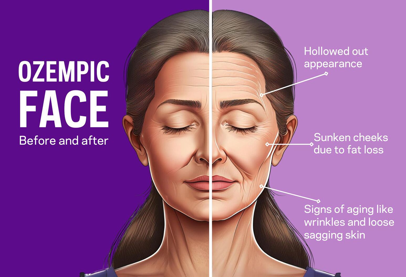 Ozempic for weight loss: What you need to know | Northwell Health