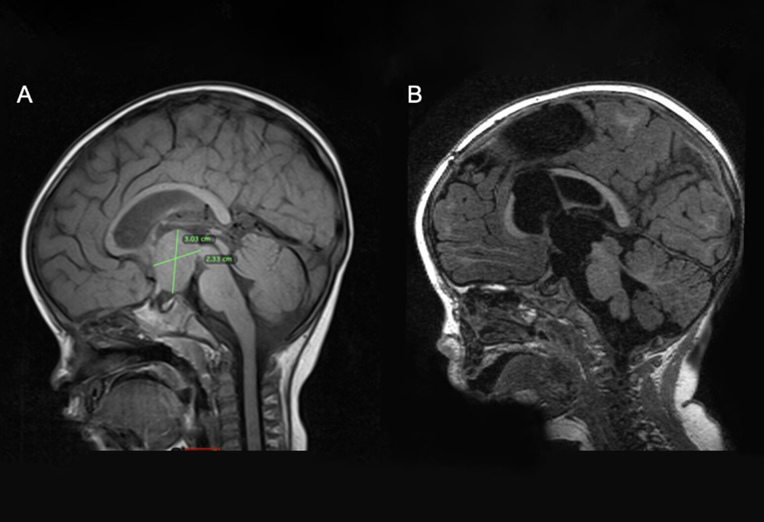 Hypothalamic Hamartoma Center - Institute for Neurology and Neurosurgery | Northwell Health