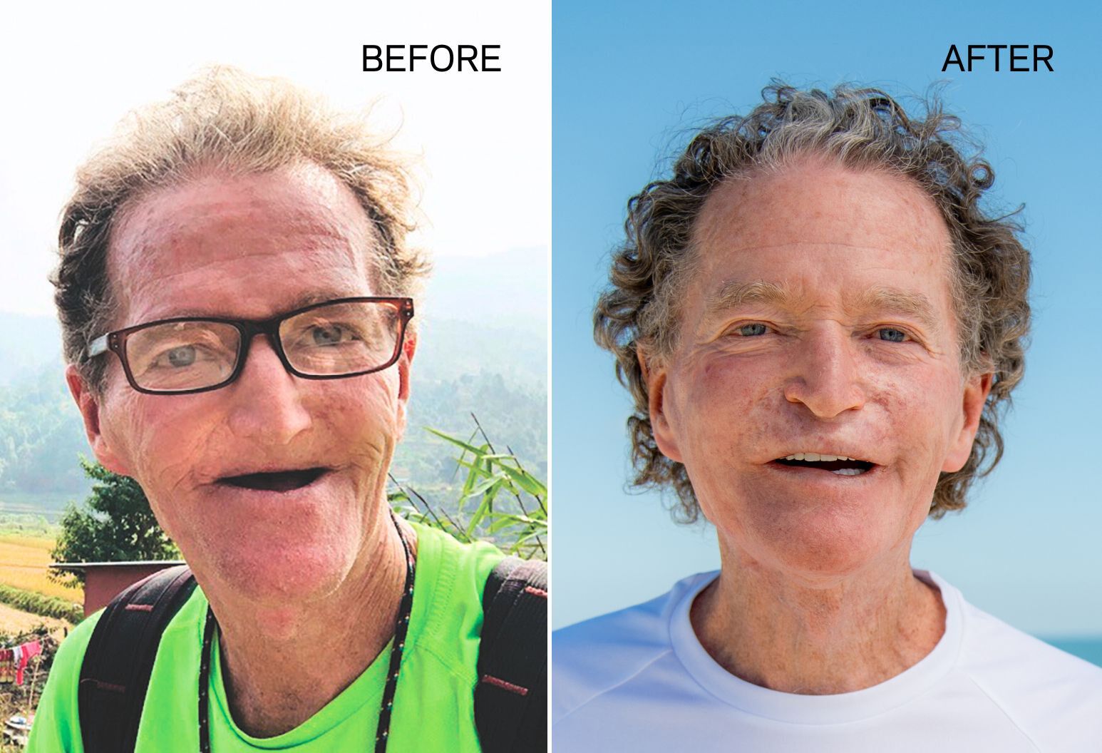 Jaw in a-Day surgery restores squamous cell carcinoma survivor’s face ...